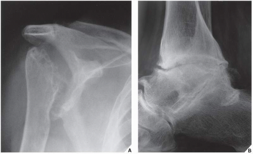 Miscellaneous Arthritides and Arthropathies | Radiology Key