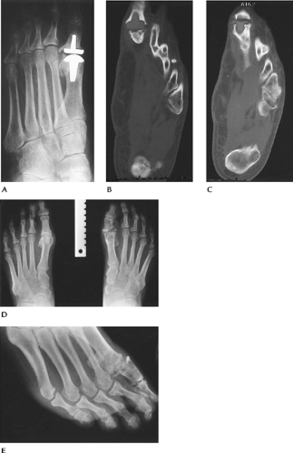 Orthopedic Appliances and Prostheses | Radiology Key