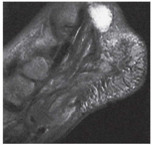 Osteomyelitis, Infectious Arthritis, and Soft-Tissue Infections ...