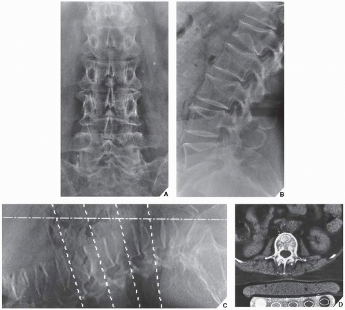 Radiologic Evaluation of Metabolic and Endocrine Disorders | Radiology Key