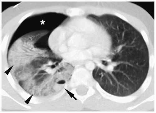 Lung, Pleura, and Chest Wall | Radiology Key