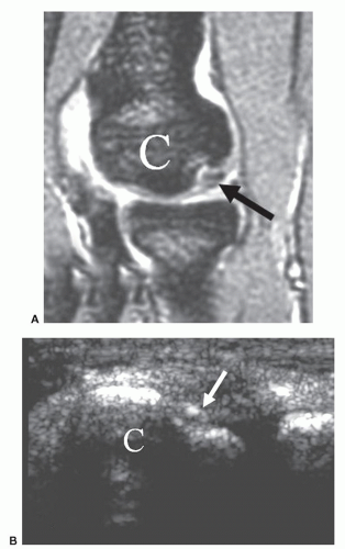 Elbow | Radiology Key