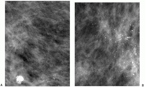 Calcifications | Radiology Key