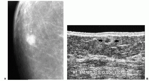 Benign Masses | Radiology Key