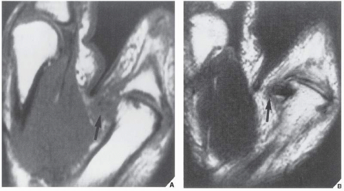 Upper Limb III: Distal Forearm, Wrist, and Hand | Radiology Key