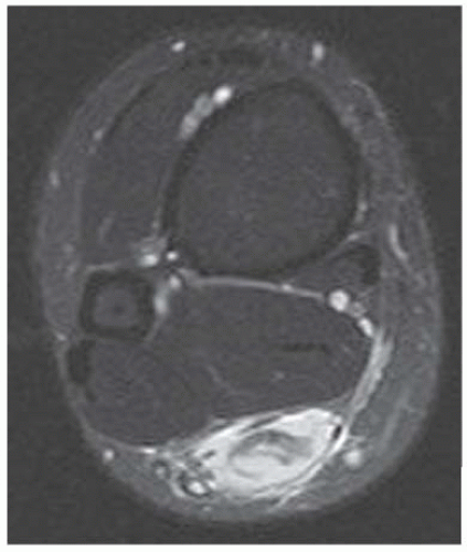 Lower Leg | Radiology Key