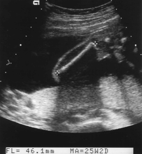 Femur Length Ultrasound Dating Gamewornauctions