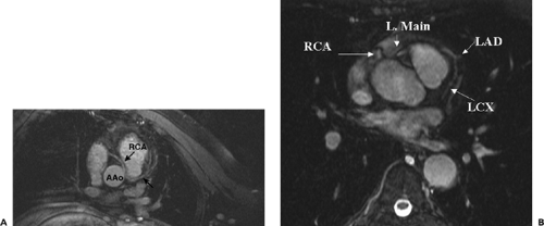Heart and Pericardium | Radiology Key