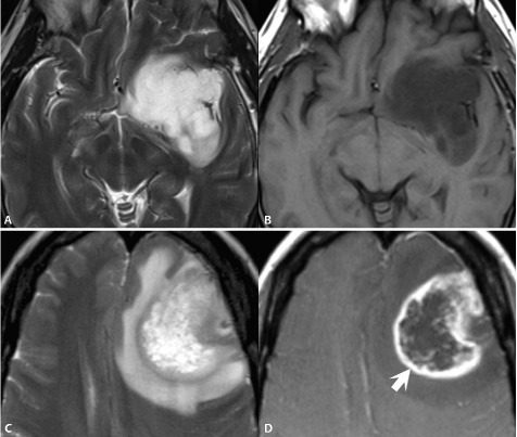 Supratentorial Brain Neoplasms | Radiology Key