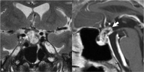 Sellar/Parasellar Neoplasms | Radiology Key