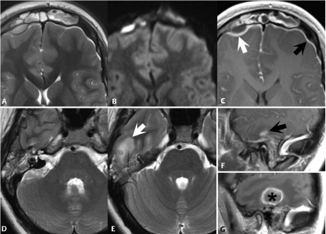 Sinus Disease | Radiology Key