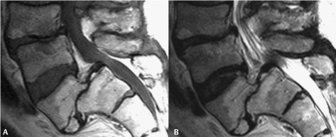 Disk Herniations | Radiology Key
