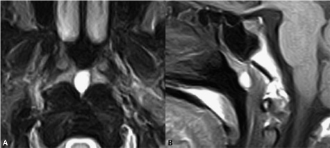 Common Incidental Findings | Radiology Key