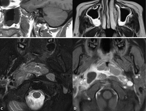 Infections | Radiology Key