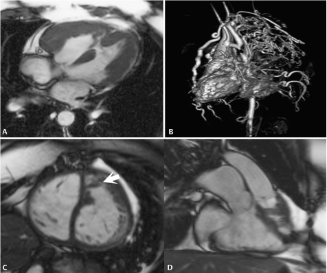 Congenital Heart Disease | Radiology Key