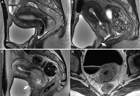 Endometrial Cancer | Radiology Key