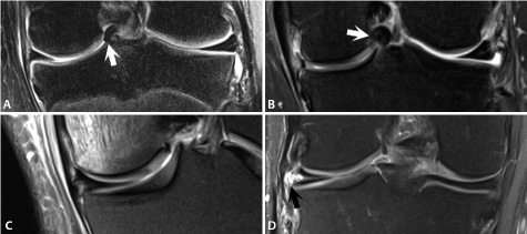 Meniscal Tears II | Radiology Key