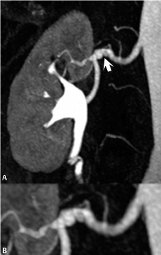 Renal Artery MRA | Radiology Key