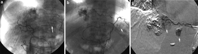 Anatomy and Its Implication in Radioembolization | Radiology Key
