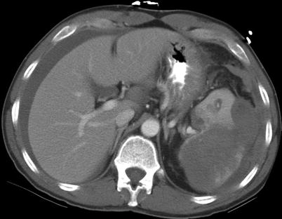 Spleen Biopsy | Radiology Key