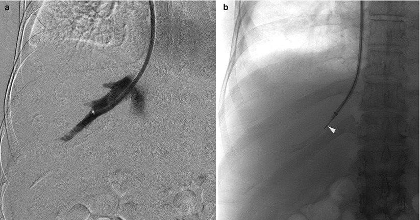 Fluoroscopy-Guided Biopsy | Radiology Key