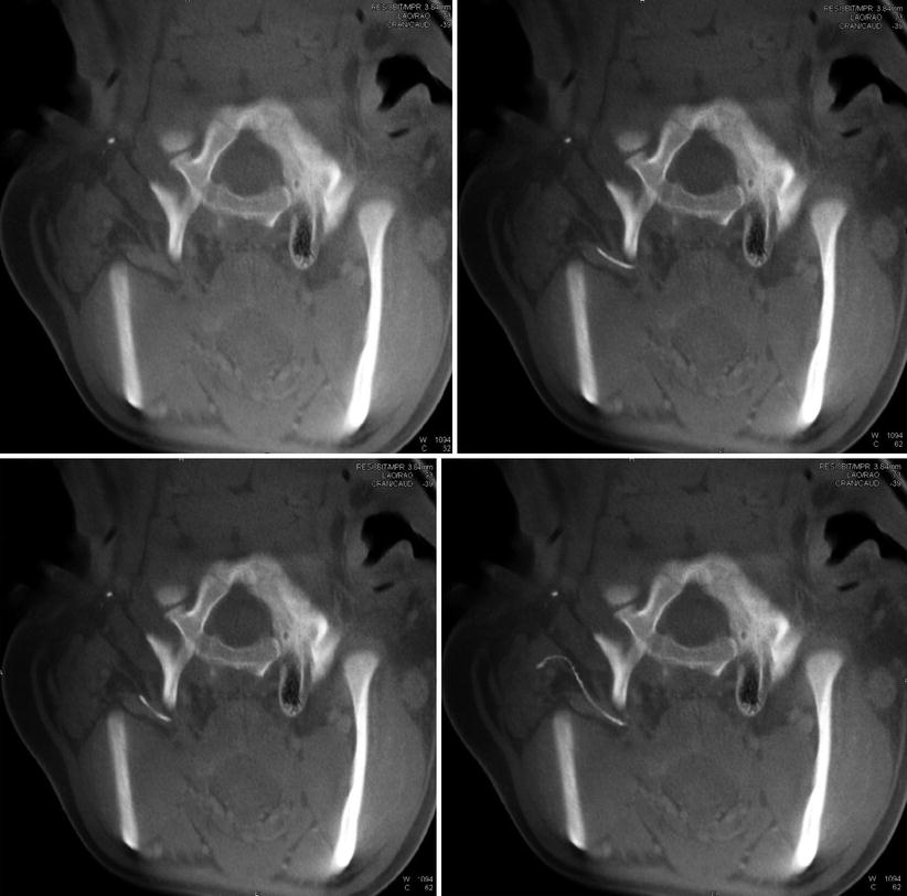 CT-Guided Interventions: Current Practice and Future Directions ...