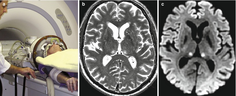 High-Field Intraoperative MR-Guided Neurosurgery | Radiology Key