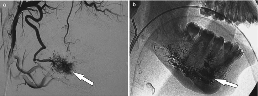 Image-Guided Bone Interventions | Radiology Key