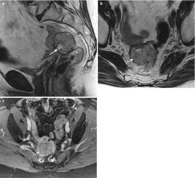 Vulvar Cancer | Radiology Key