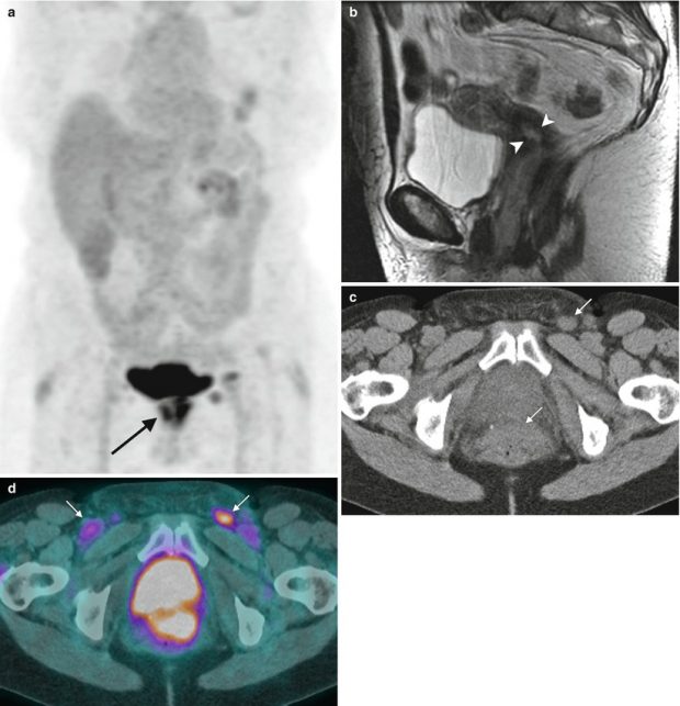 Vulvar Cancer | Radiology Key