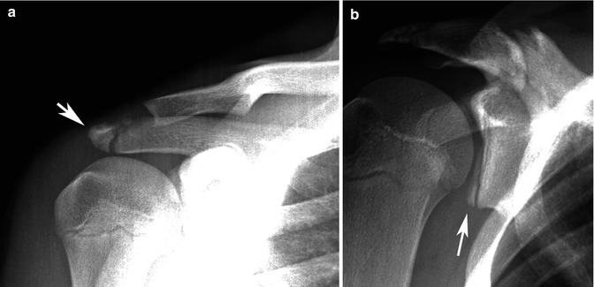 Shoulder and Upper Arm | Radiology Key