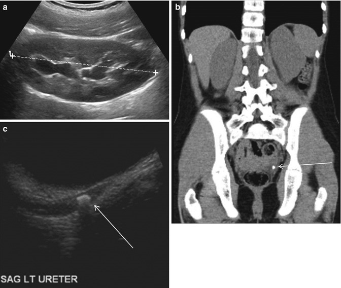 Renal Imaging: Hydronephrosis and Renal Obstruction | Radiology Key