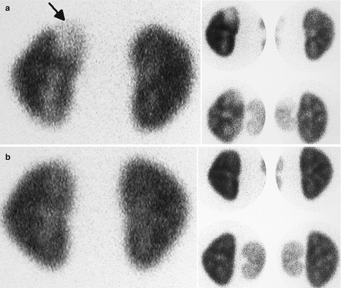 Renal Imaging: Infection | Radiology Key