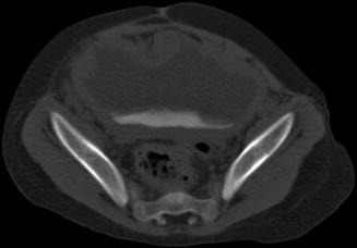 Urolithiasis | Radiology Key