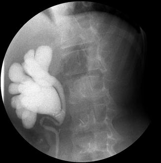 Principles of Voiding Cystourethrography (VCUG) | Radiology Key