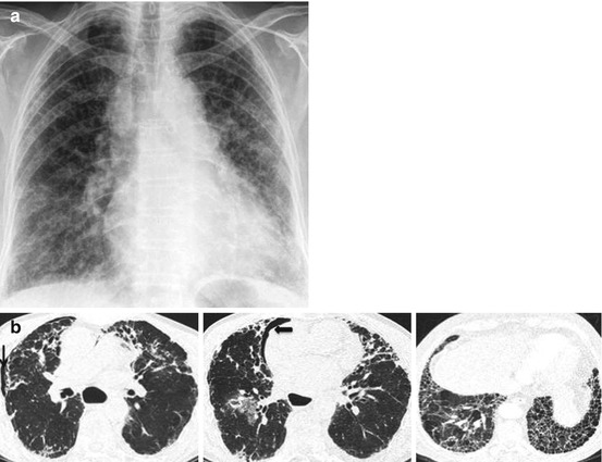 Hypercarbia and Difficulties in Mechanical Ventilation | Radiology Key