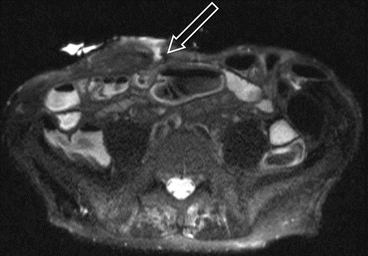 Post-operative Trans-Abdominal Wall Succus Entericus or Stool Drainage ...