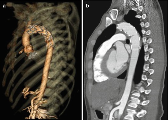 Chest Trauma: Blunt Aortic and Cardiac Trauma | Radiology Key