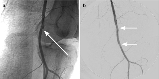 Vascular Trauma | Radiology Key