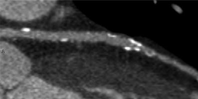 Evaluation of the Myocardial Supply-Fast kV-Switching Dual-Energy CT ...