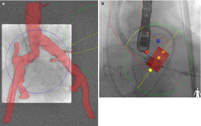 Transcatheter Aortic Valve Replacement in Patients with Chronic Kidney ...