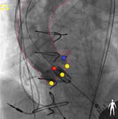 Angiography and Rotational Angiography for TAVR | Radiology Key