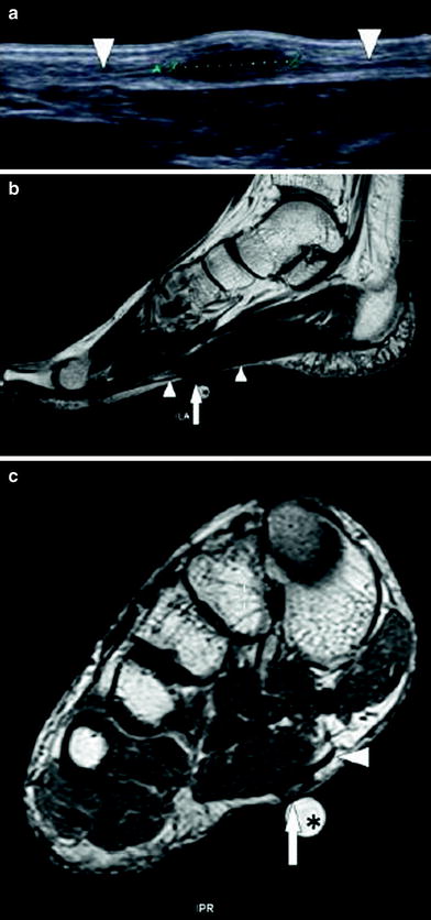 in Muscle Tumors and Tumors of Fasciae and Tendon Sheaths | Radiology Key