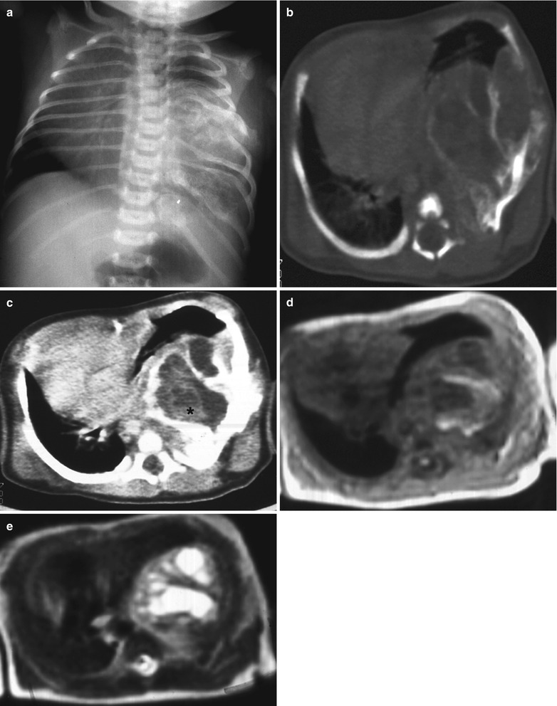 Pediatric Uterus, Ovary, and Testis Diseases | Radiology Key