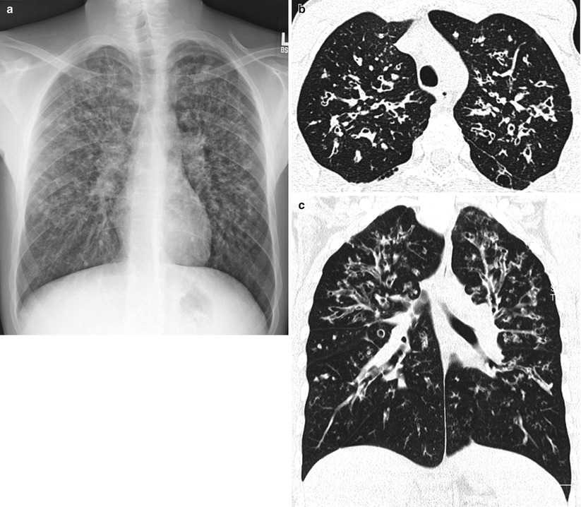 Pediatric Diffuse Lung Disease | Radiology Key