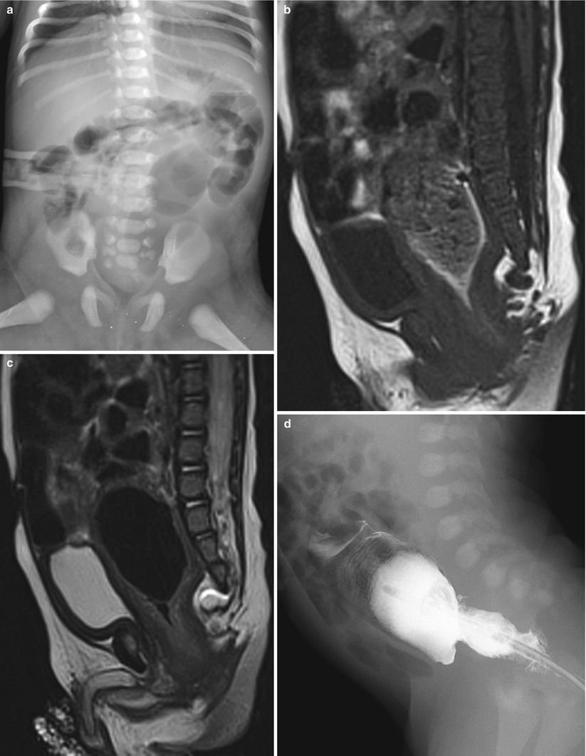 Congenital and Neonatal Gastrointestinal Diseases | Radiology Key