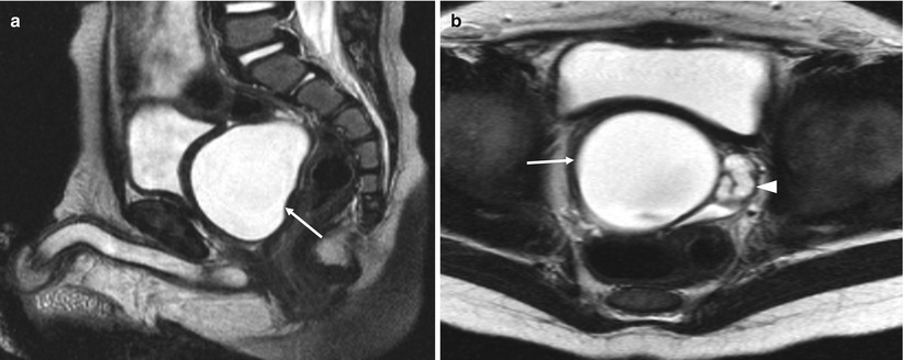 Bladder and Urethra Disease | Radiology Key