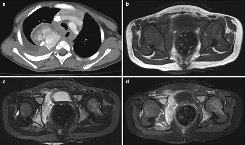 Pediatric Bone Tumors | Radiology Key