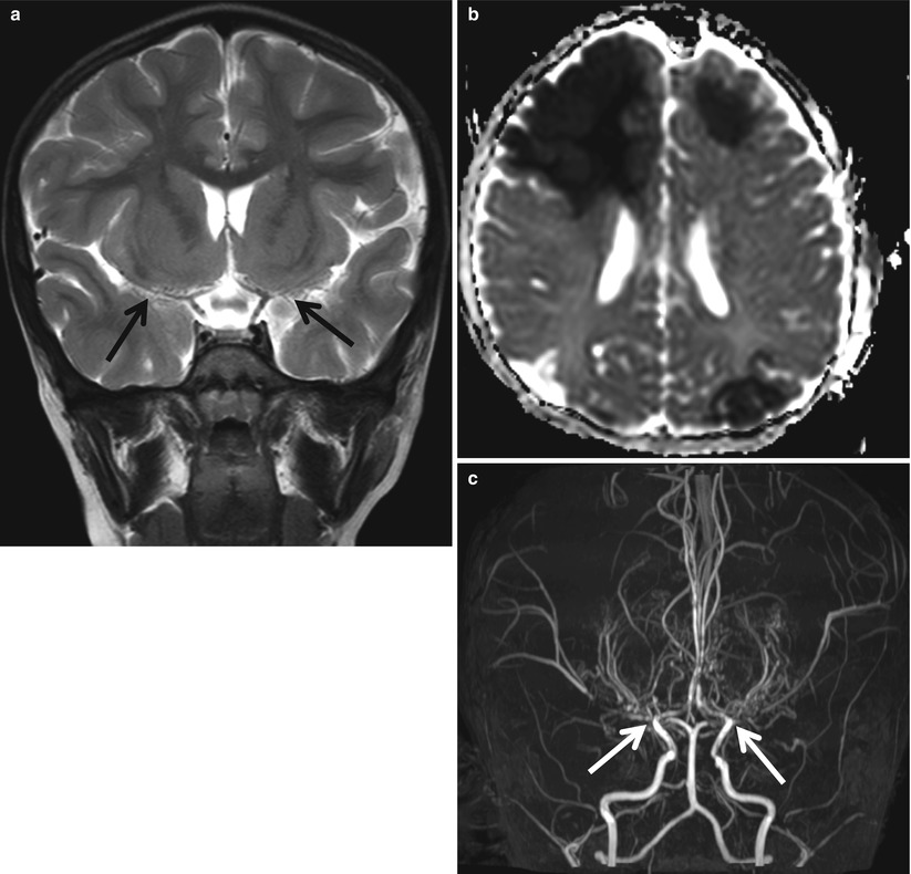 Brain and Spine Injury and Cerebral Vascular Disorders | Radiology Key