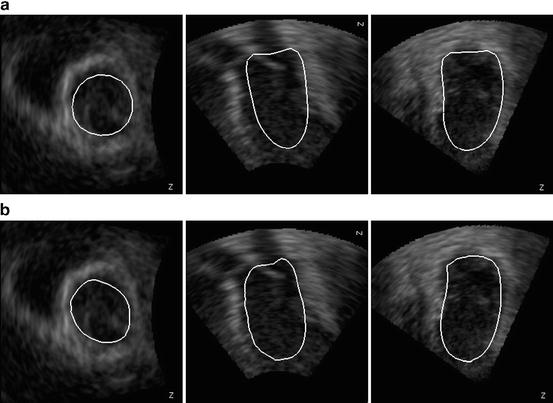 Constrained Marginal Space Learning | Radiology Key